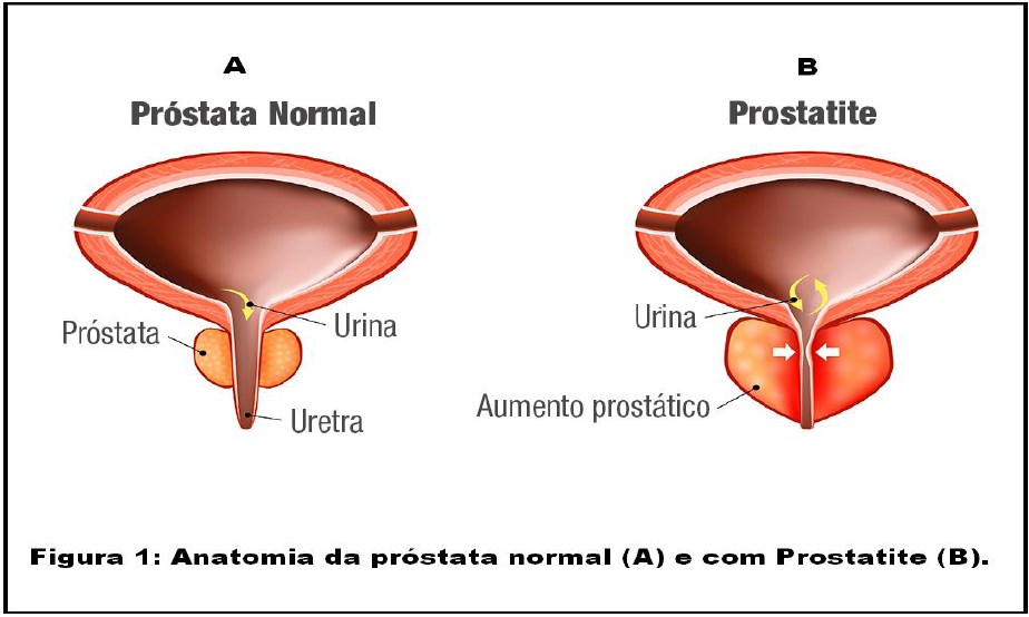 Prostatite: Sintomas, Causas e Tratamentos