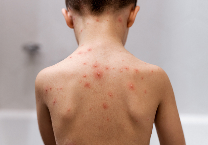 Catapora ou varicela: sintomas, tratamento e prevenção | Einstein