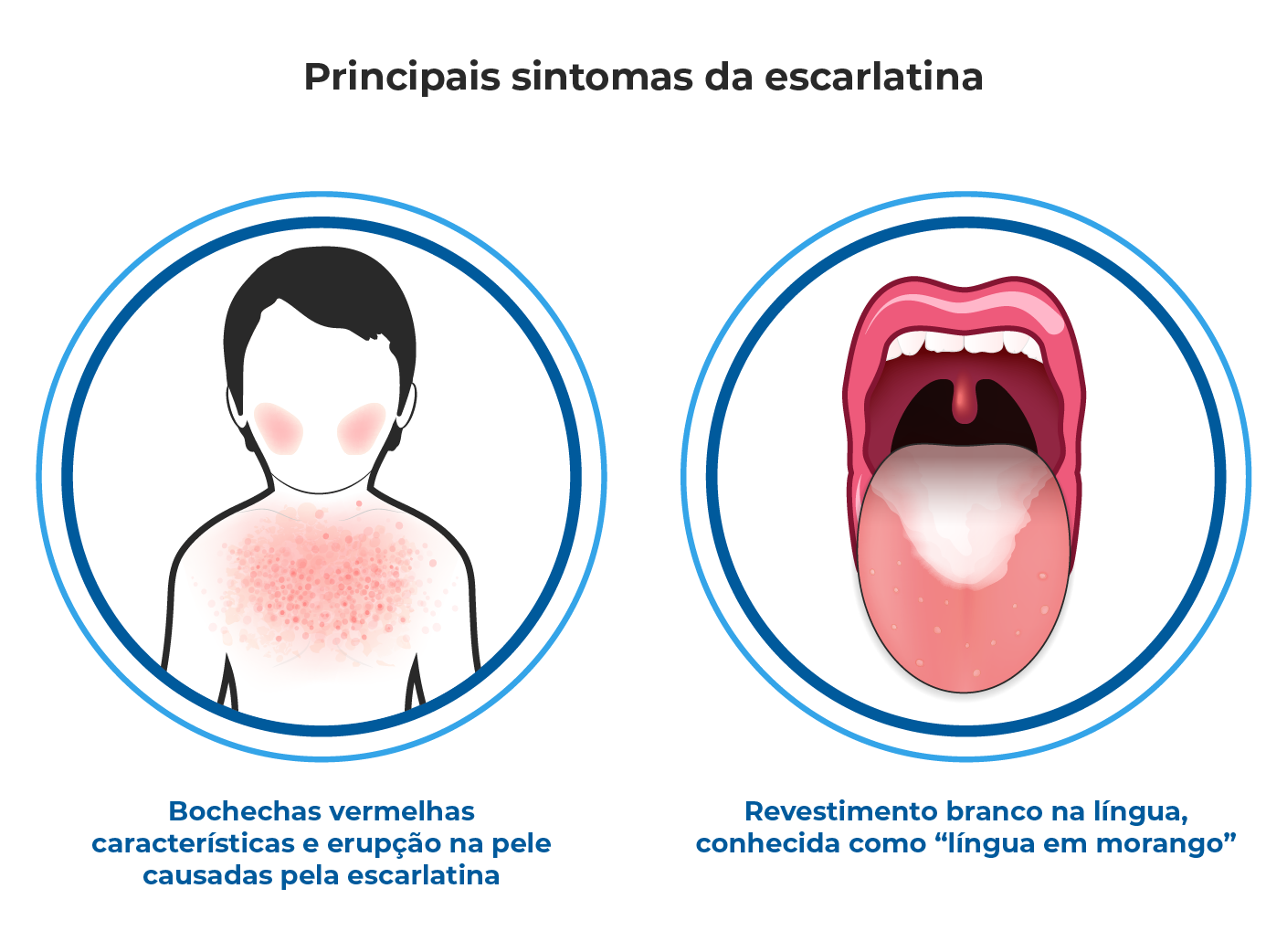 Escarlatina: Sintomas, Causas e Tratamentos