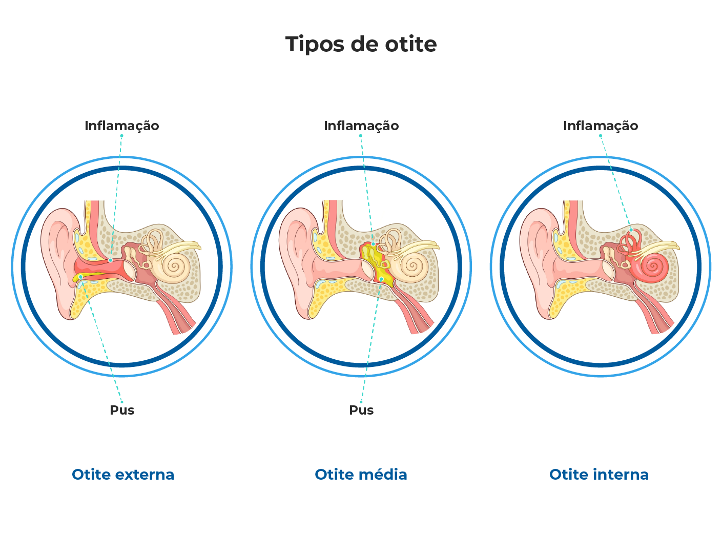 Otite: Sintomas, Causas e Tratamentos