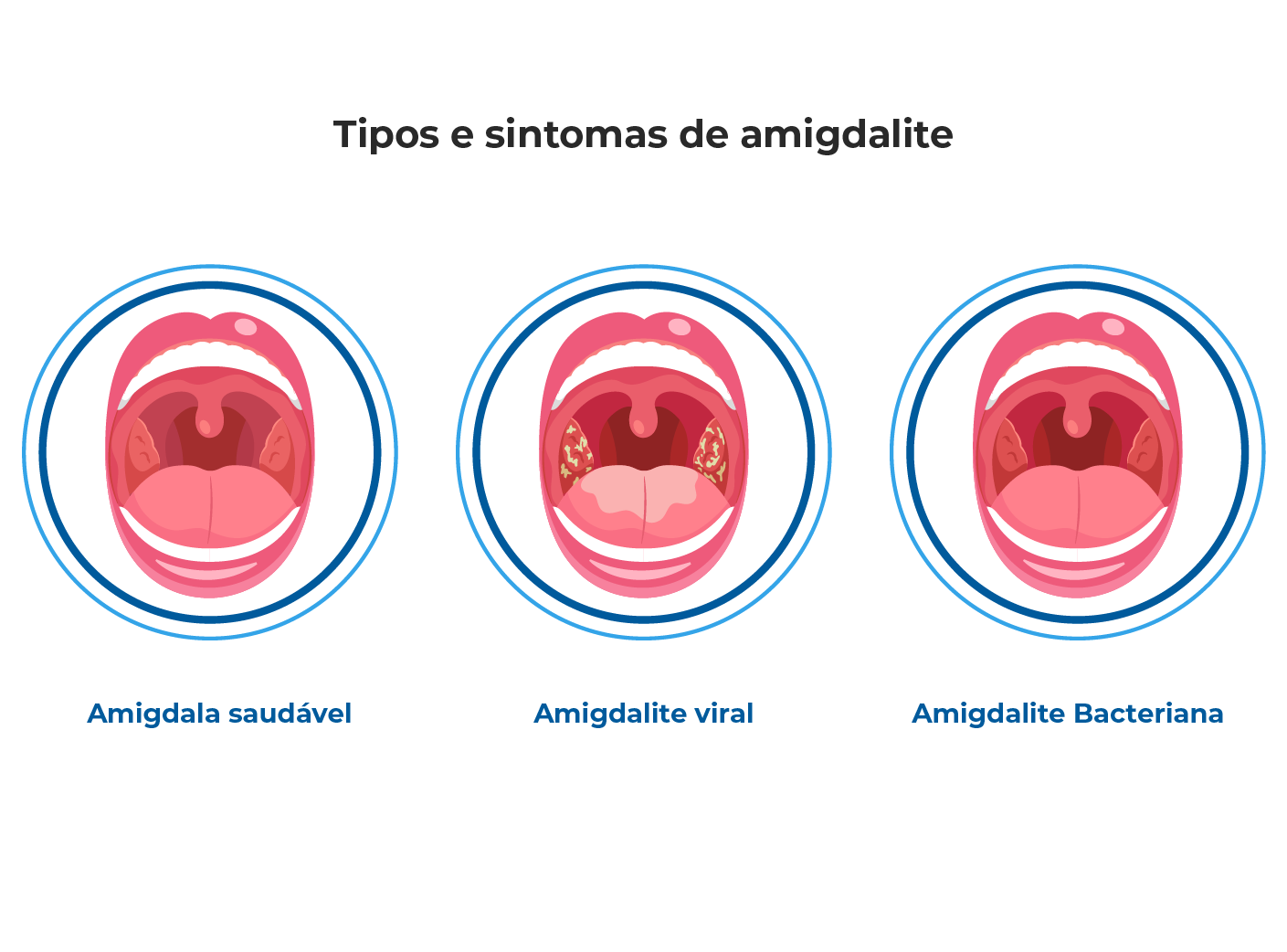 Amigdalite: Sintomas, Causas e Tratamentos