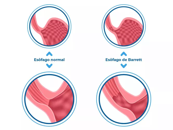 Esôfago de Barrett: Sintomas, Causas e Tratamentos