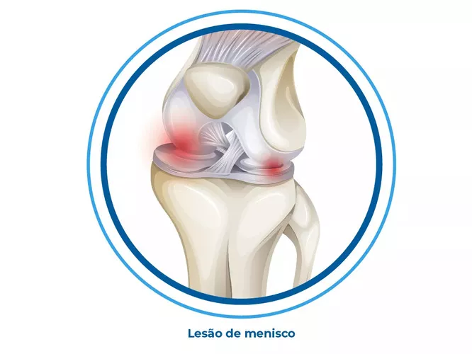 Lesão no menisco: Sintomas, Causas e Tratamentos