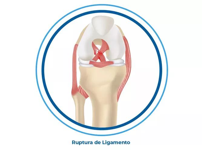 Ruptura de ligamento: Sintomas, Causas e Tratamentos