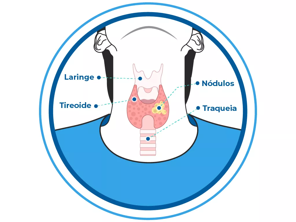 Câncer de tireoide: Sintomas, Causas e Tratamentos