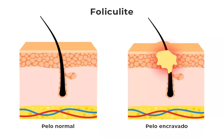 Foliculite: Sintomas, Causas e Tratamentos