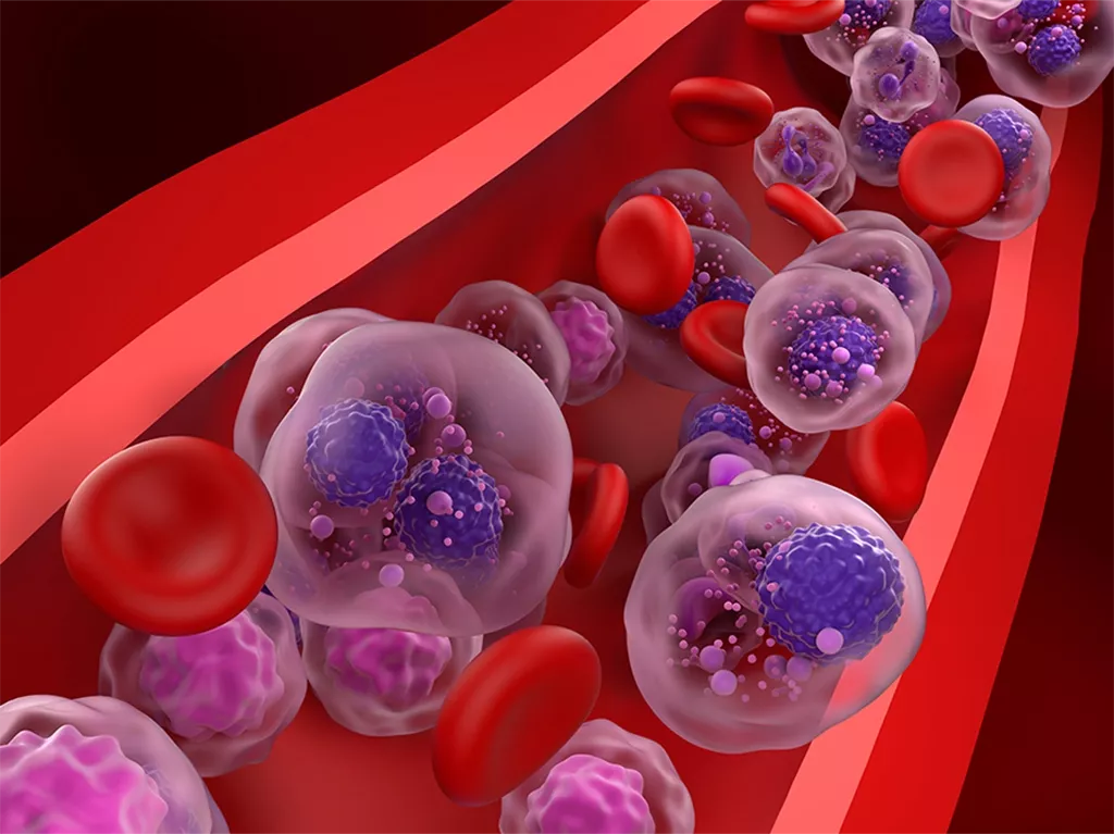 Mieloma múltiplo: Sintomas, Causas e Tratamentos